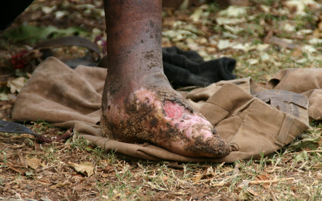 Mossy Foot Diseased Foot | Mossy Foot Project
