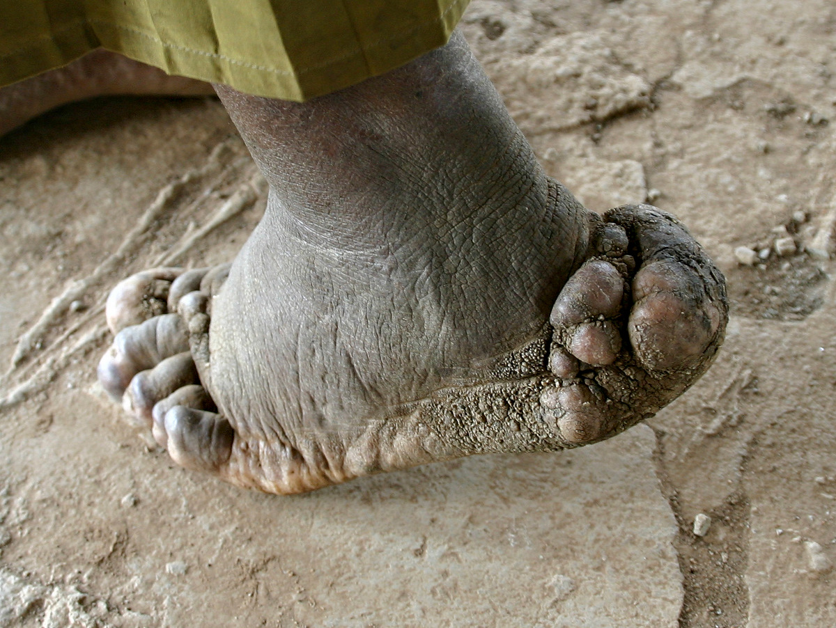 Foot Rot Disease In Humans At Kate Donaghy Blog